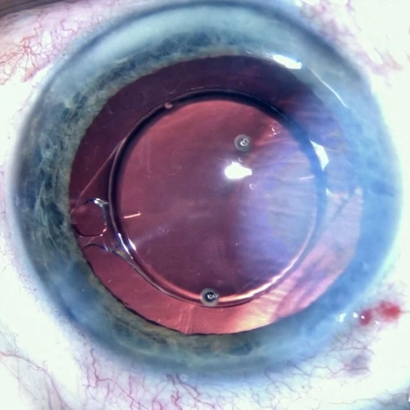 Lentes intraoculares: mejora tu visión | OLO Vision Center